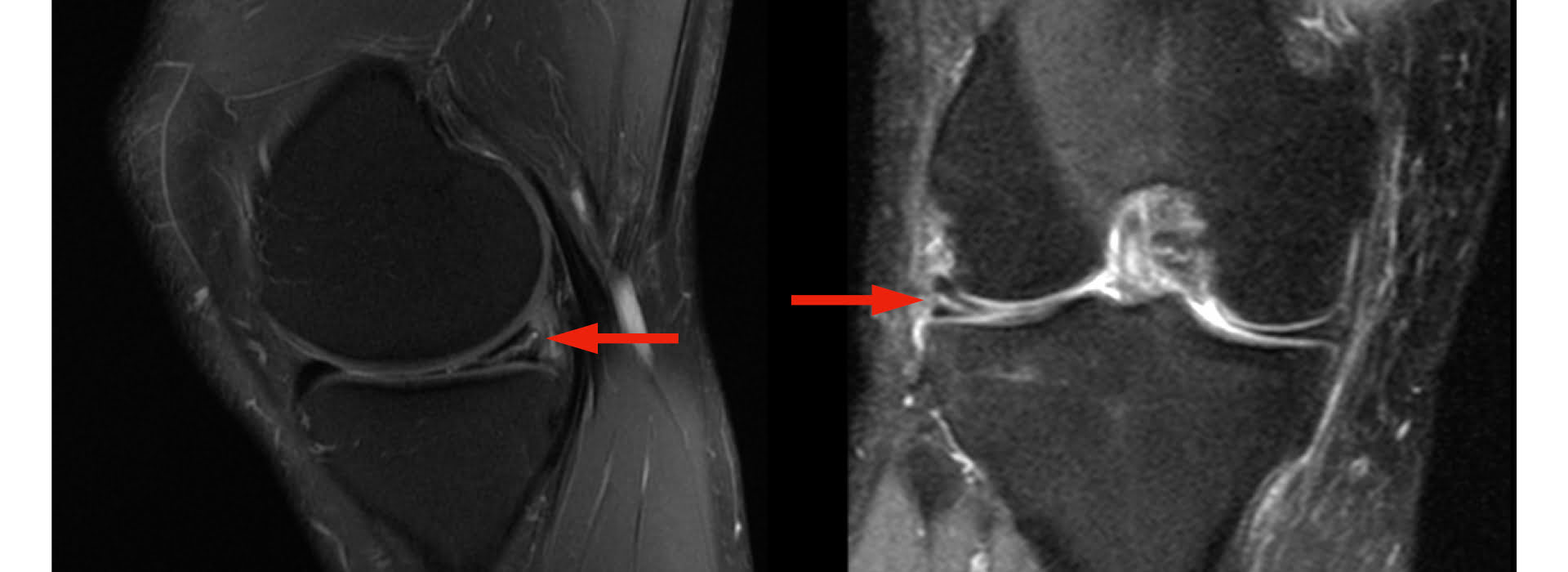 Ruptura de menisc | Dr. Dragos Popescu | Chirurgia Genunchiului