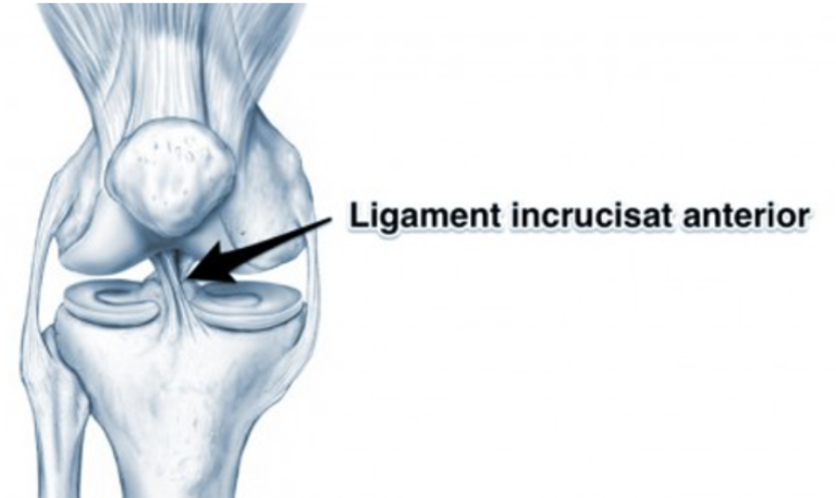 Ruptura ligament incrucisat anterior (LIA) - Cauze, simptome, operatia ...