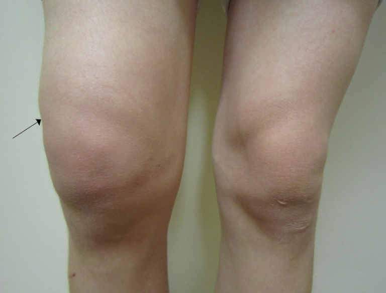 Genunchi umflat - Cauze & Tratament | Chirurgia Genunchiului