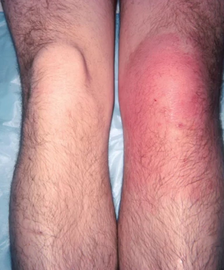 Genunchi umflat - Cauze & Tratament | Chirurgia Genunchiului